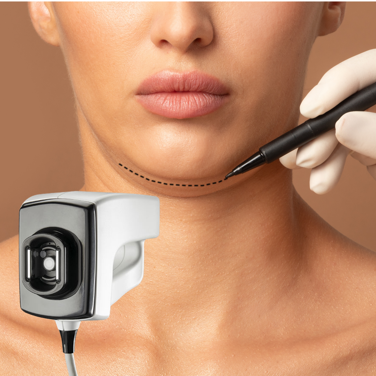 InMode MiniFx Trial – Jawline & Chin Contouring Vancouver